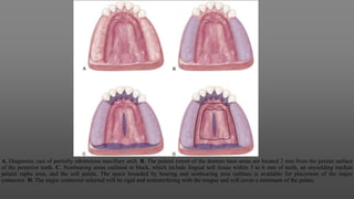 Maxillary major connectors | PPTX