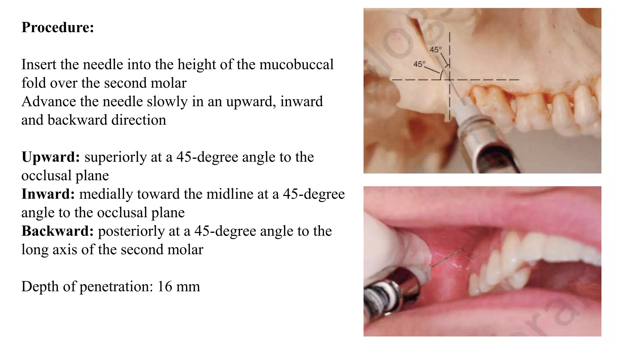 Maxillary nerve block | PPTX