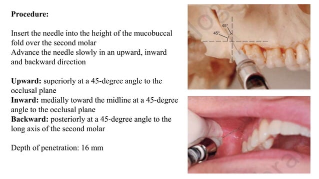 Maxillary nerve block | PPTX
