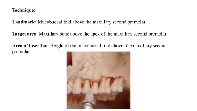 Maxillary nerve block | PPTX