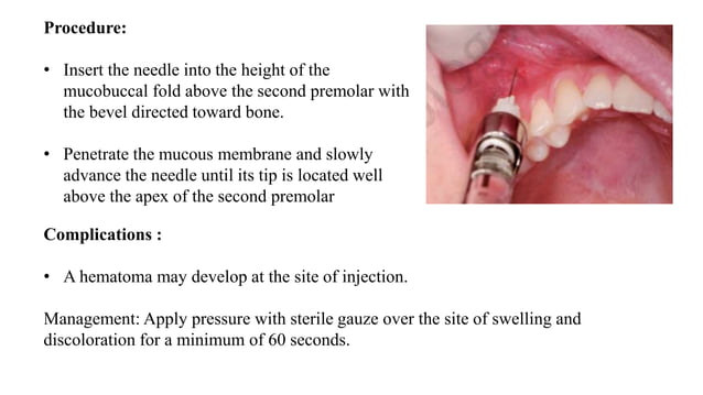 Maxillary nerve block | PPTX
