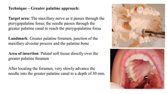 Maxillary nerve block | PPTX