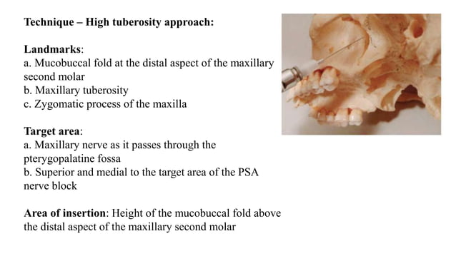 Maxillary nerve block | PPTX