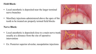 Maxillary nerve block | PPTX