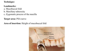 Maxillary Nerve Block High Tuberosity Approach