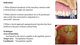 Maxillary Nerve Block High Tuberosity Approach