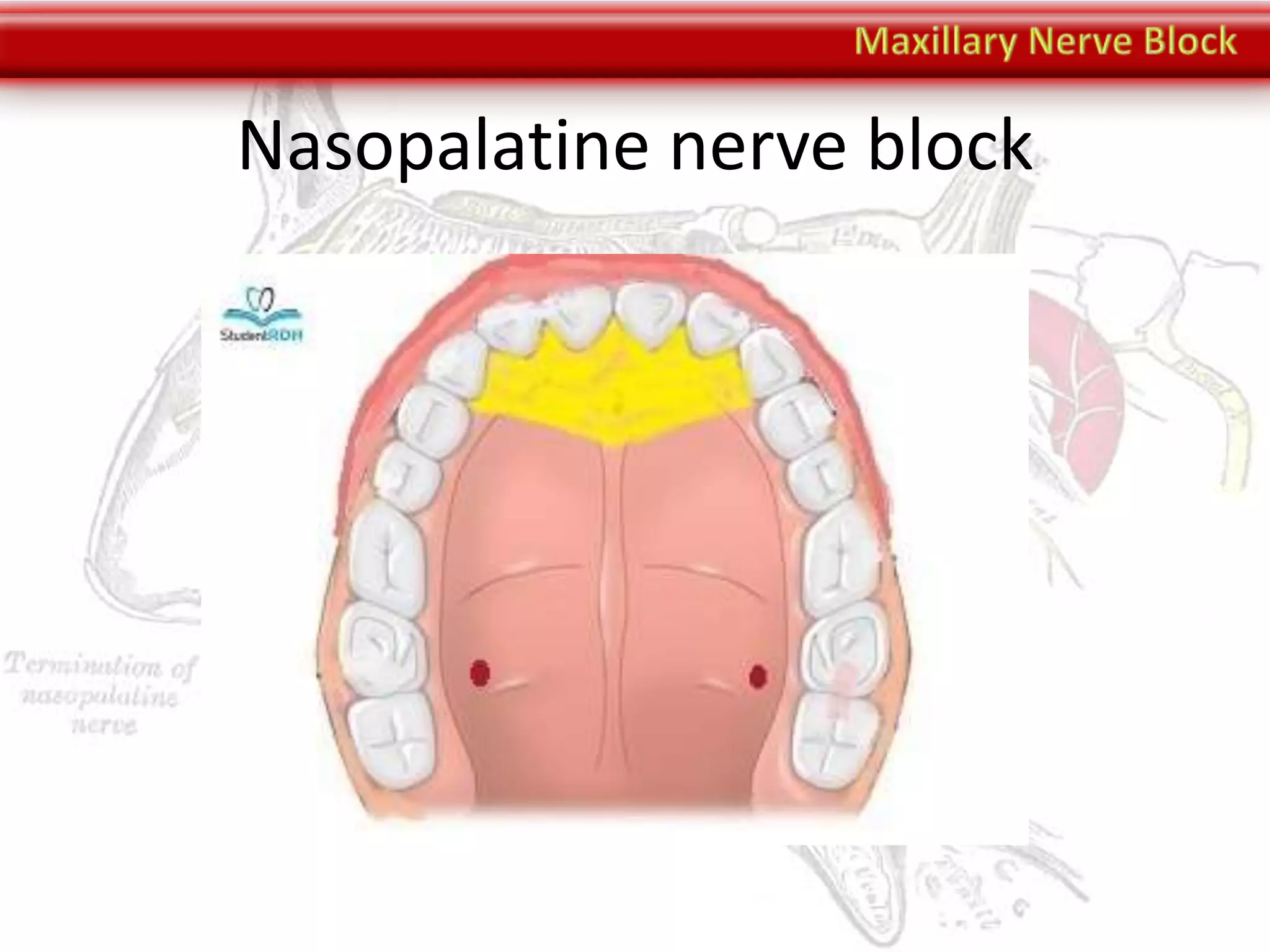 Maxillary nerve block.pptx