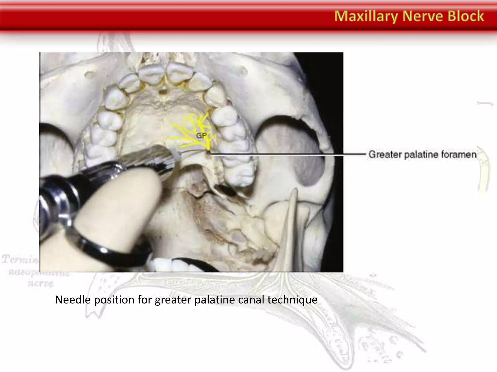 Maxillary nerve block.pptx