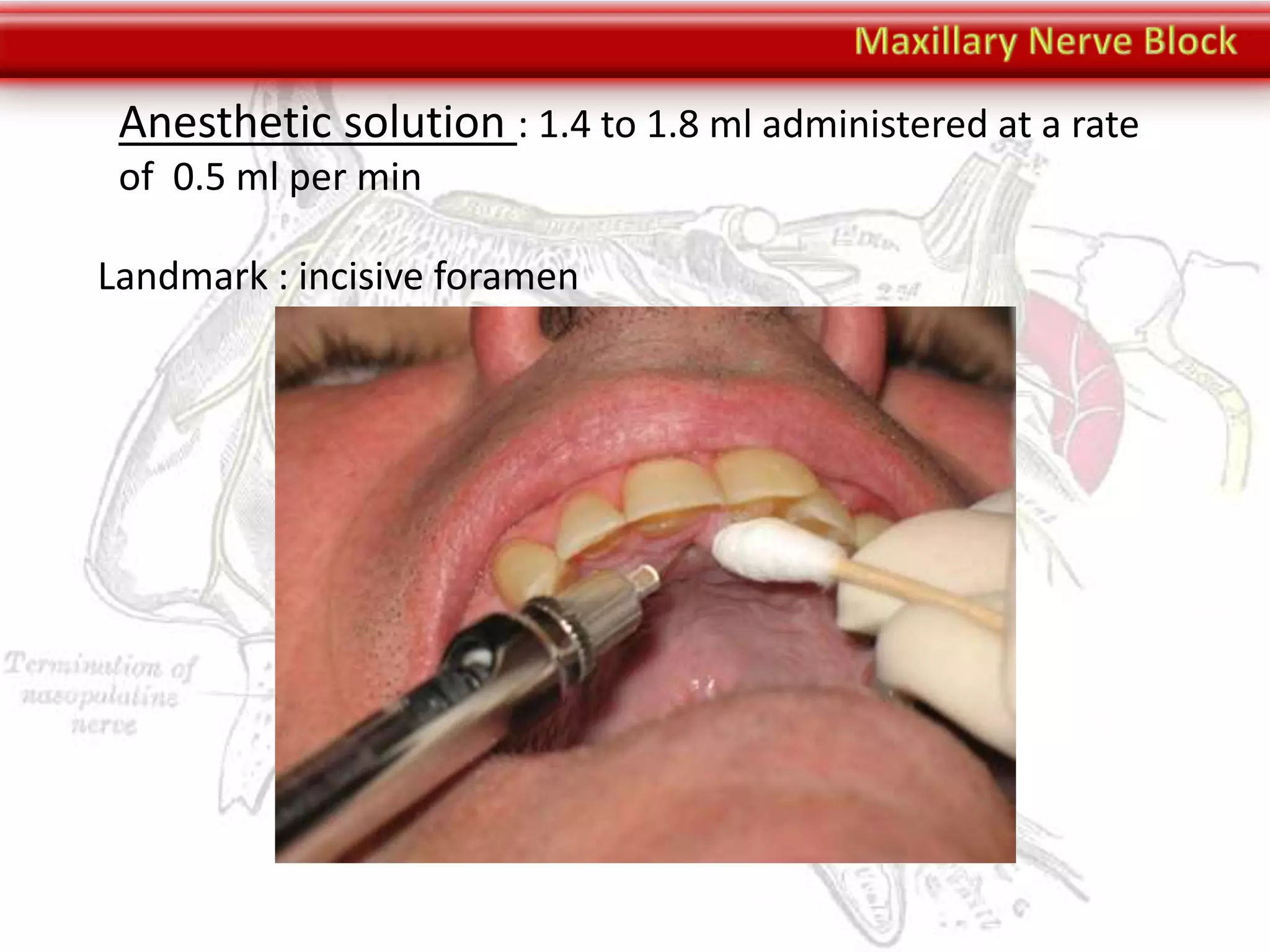Maxillary nerve block.pptx