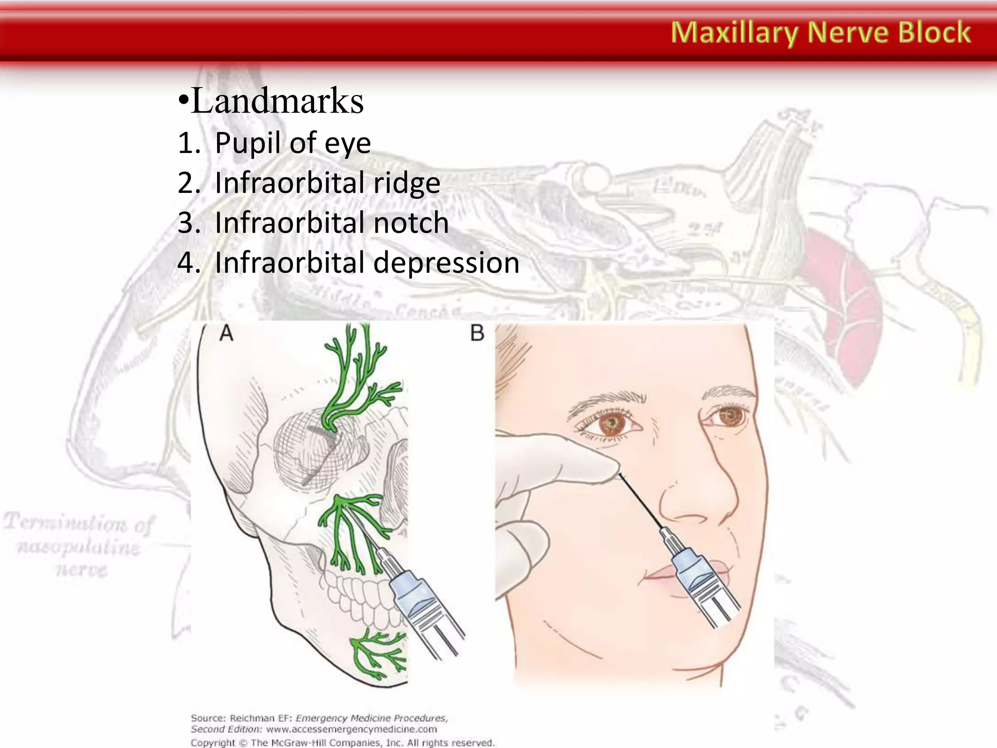 Maxillary nerve block.pptx