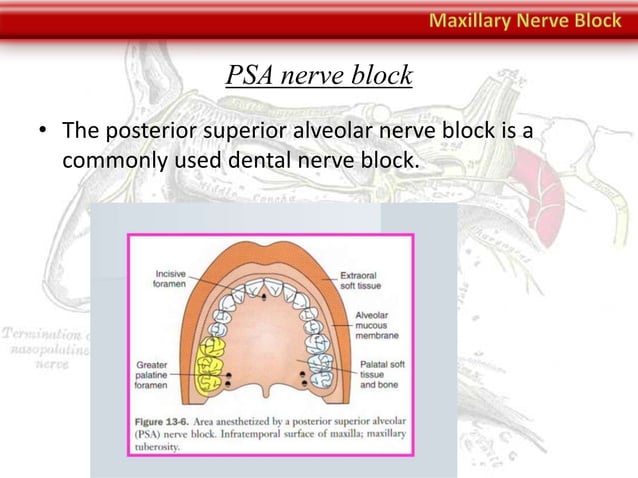 Maxillary nerve block.pptx