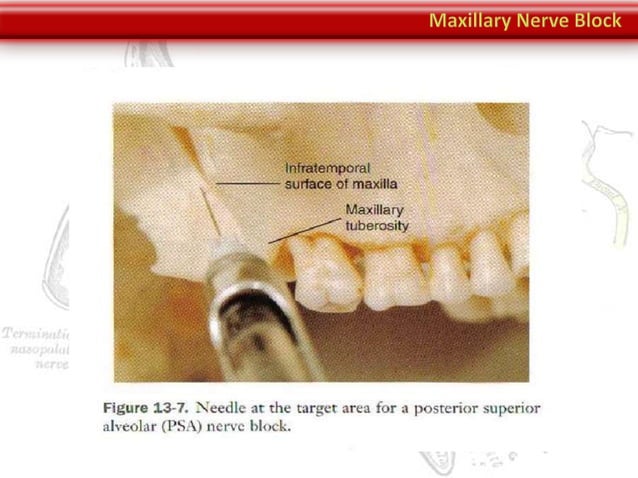 Maxillary nerve block.pptx