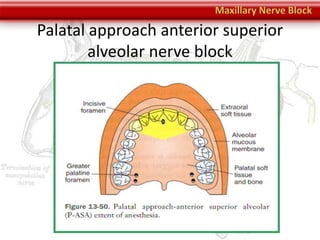 Maxillary nerve block.pptx