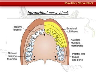 Maxillary nerve block.pptx