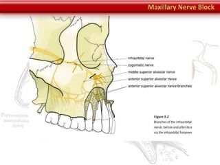 Maxillary nerve block.pptx
