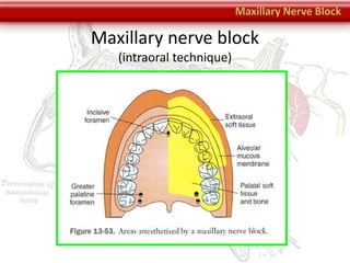Maxillary Nerve Block