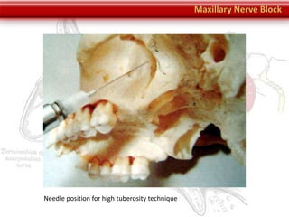 Maxillary Nerve Block High Tuberosity Approach