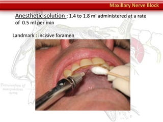 Maxillary Nerve Block High Tuberosity Approach