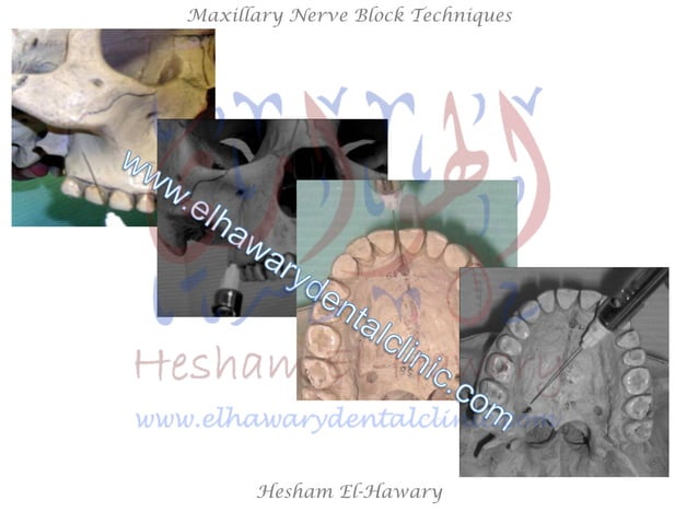 Maxillary nerve block anesthetic technique (with photos) | PDF | Ear ...