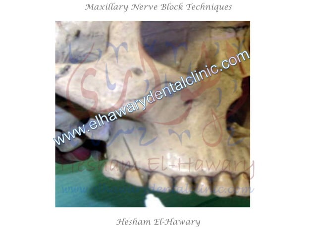 Maxillary nerve block anesthetic technique (with photos) | PDF | Ear ...