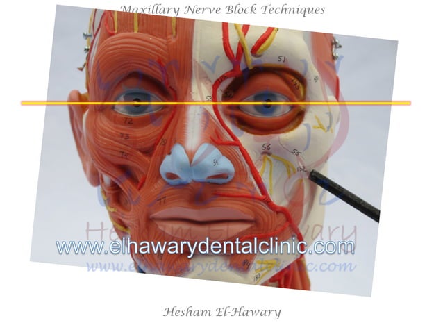 Maxillary nerve block anesthetic technique (with photos) | PDF | Ear ...