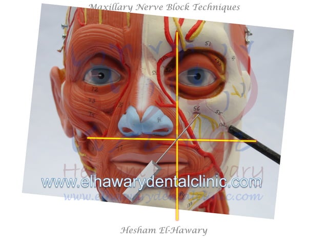 Maxillary nerve block anesthetic technique (with photos) | PDF | Ear ...