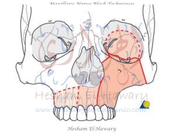Maxillary nerve block anesthetic technique (with photos) | PDF | Ear ...