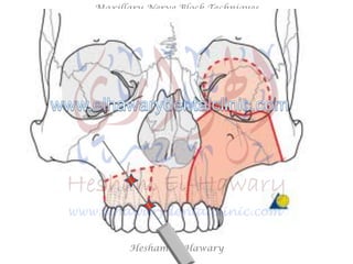 Maxillary Nerve Block Technique