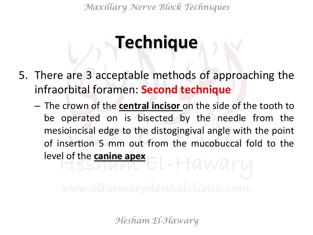 Maxillary Nerve Block Anesthetic Technique With Photos
