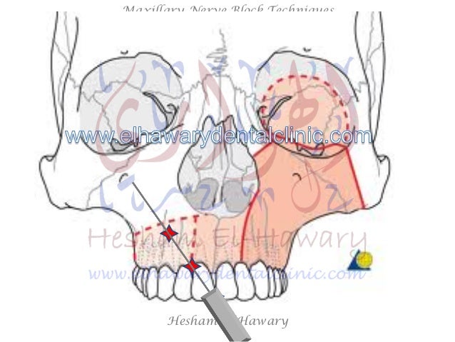 Maxillary nerve block anesthetic technique (with photos)