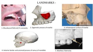 MAXILLARY NERVE BLOCKS.pptx