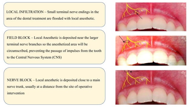 MAXILLARY NERVE BLOCKS.pptx | Ear, Nose and Throat Conditions ...