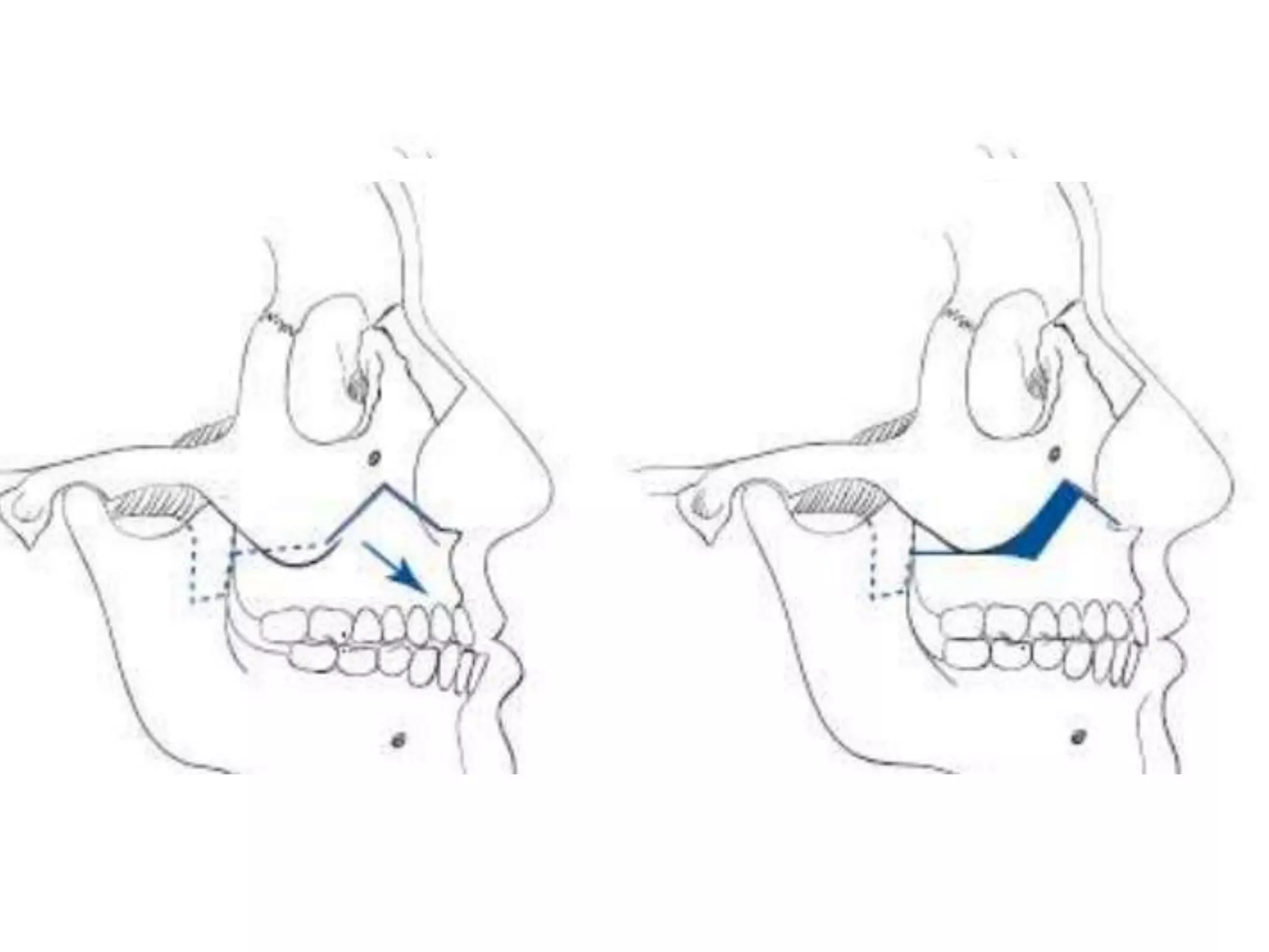 Maxillary Orthognathic surgery | PPTX