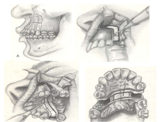 Maxillary Orthognathic surgery