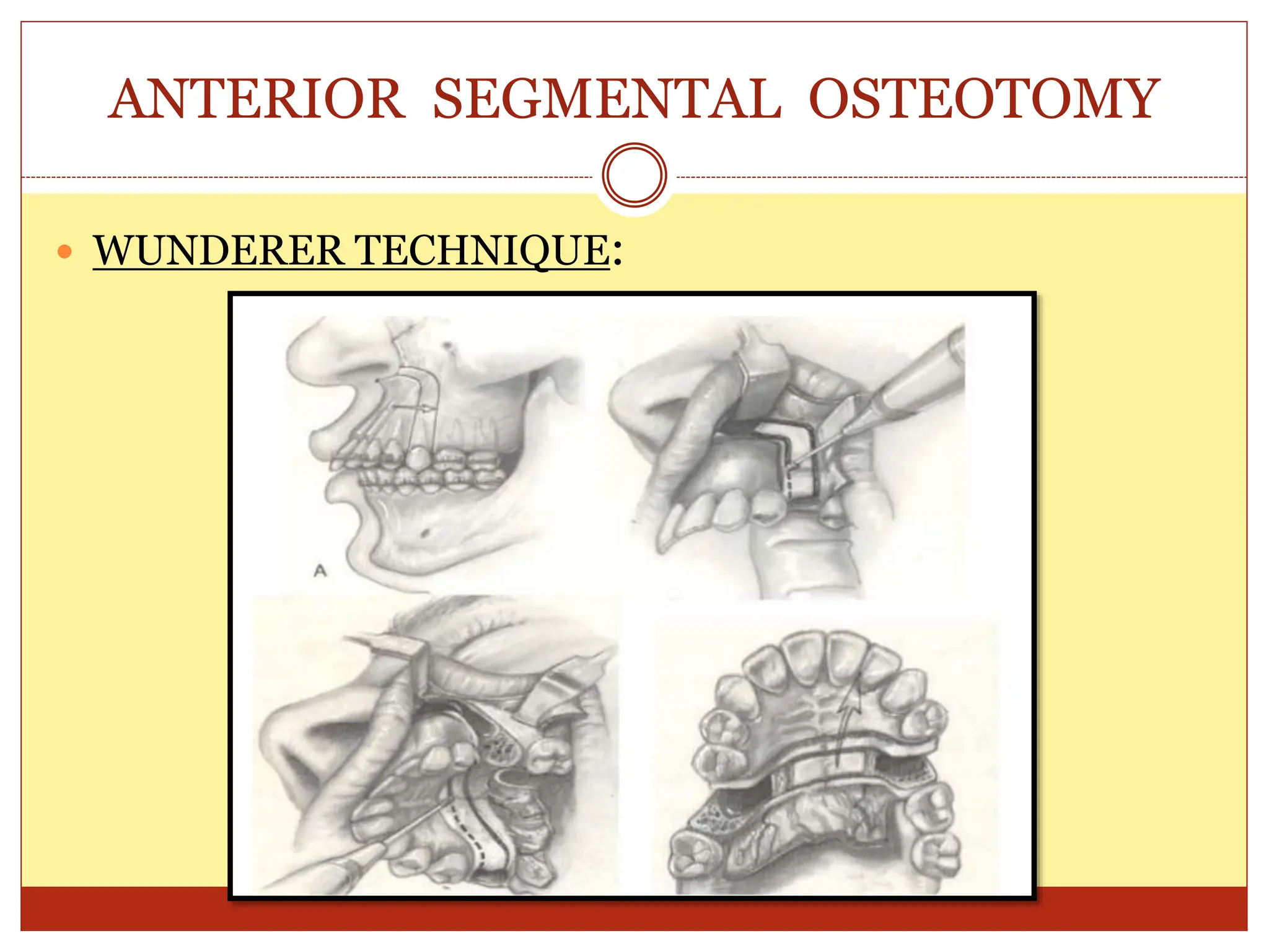 MAXILLARY ORTHOGNATHIC PROCEDURES AND SOFT TISSUE CHANGES-2.pptx