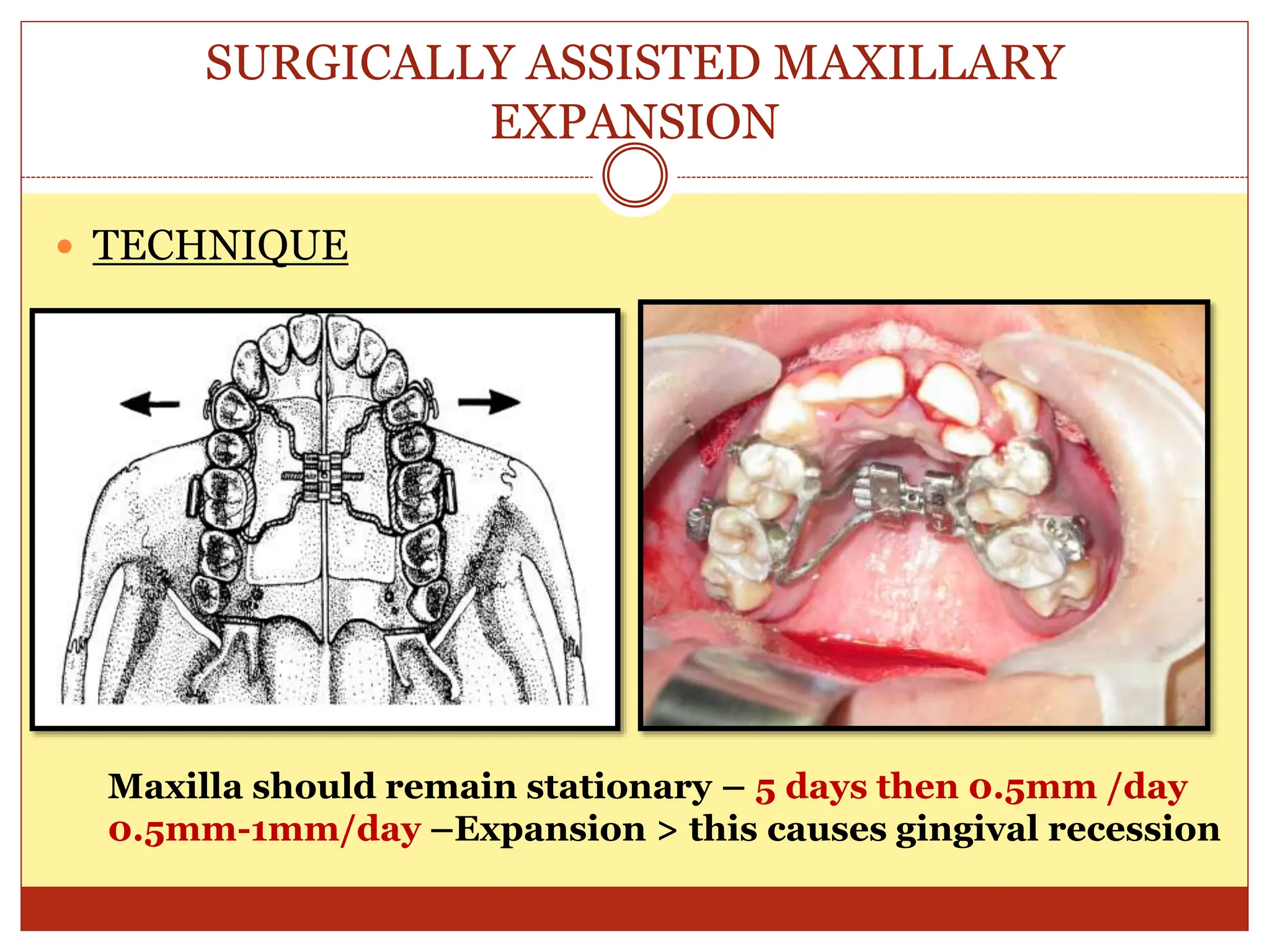 MAXILLARY ORTHOGNATHIC PROCEDURES AND SOFT TISSUE CHANGES-2.pptx