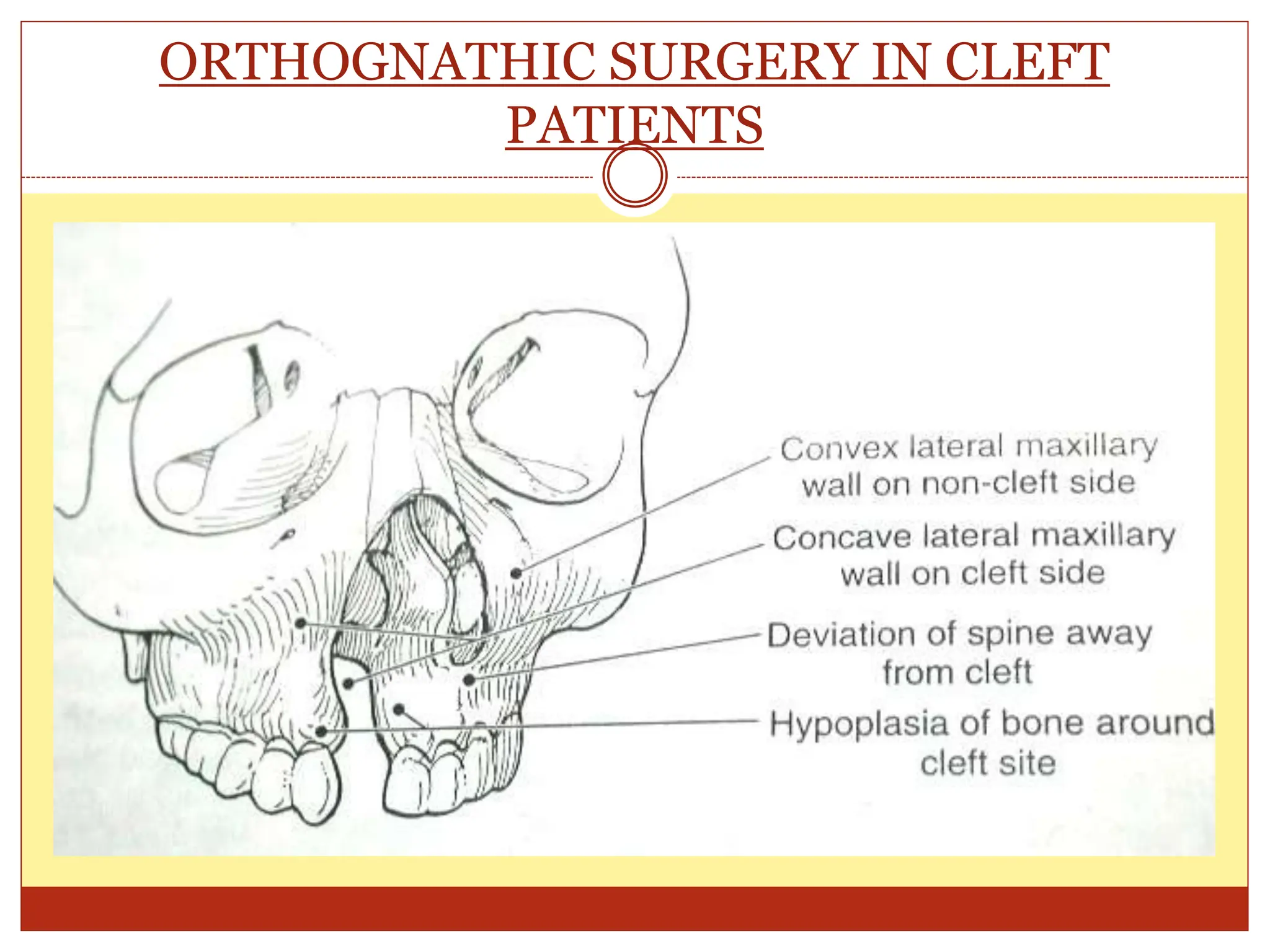 MAXILLARY ORTHOGNATHIC PROCEDURES AND SOFT TISSUE CHANGES-2.pptx