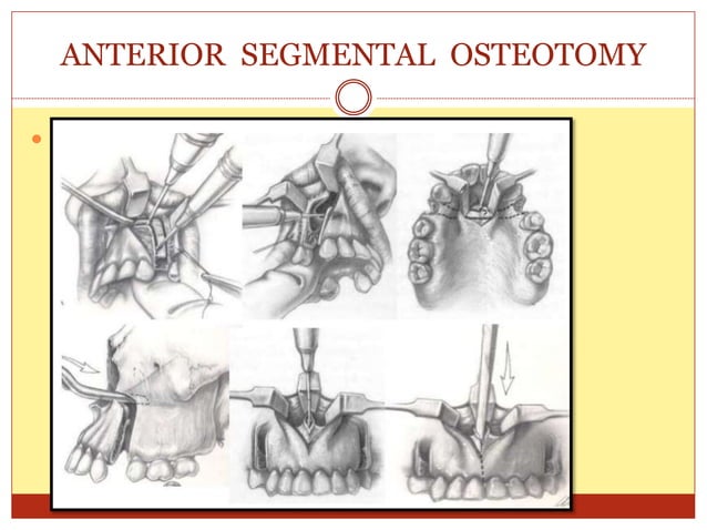 MAXILLARY ORTHOGNATHIC PROCEDURES AND SOFT TISSUE CHANGES-2.pptx ...