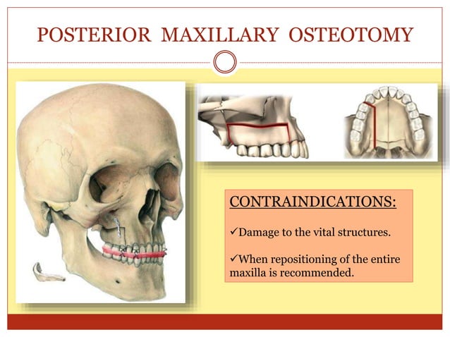 MAXILLARY ORTHOGNATHIC PROCEDURES AND SOFT TISSUE CHANGES-2.pptx ...