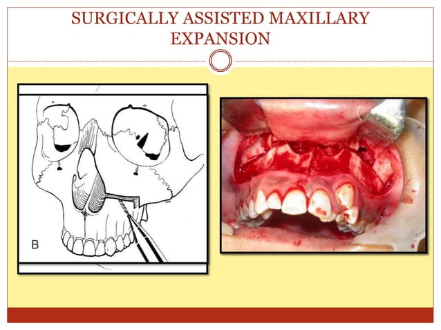MAXILLARY ORTHOGNATHIC PROCEDURES AND SOFT TISSUE CHANGES-2.pptx
