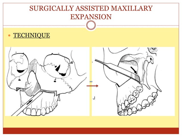 MAXILLARY ORTHOGNATHIC PROCEDURES AND SOFT TISSUE CHANGES-2.pptx ...