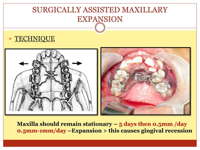 MAXILLARY ORTHOGNATHIC PROCEDURES AND SOFT TISSUE CHANGES-2.pptx ...