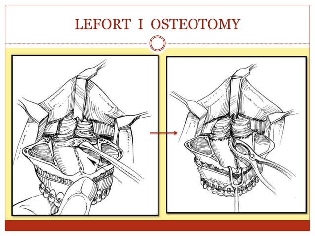 MAXILLARY ORTHOGNATHIC PROCEDURES AND SOFT TISSUE CHANGES-2.pptx ...