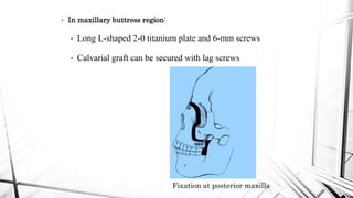 Maxillary orthognathic surgery | PPTX