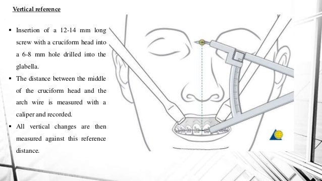Maxillary orthognathic surgery