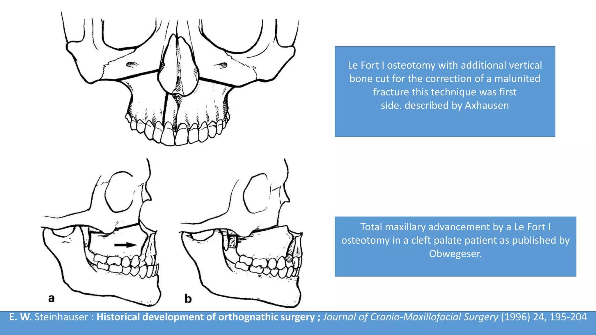 Maxillary Orthognathic Surgery | PPTX