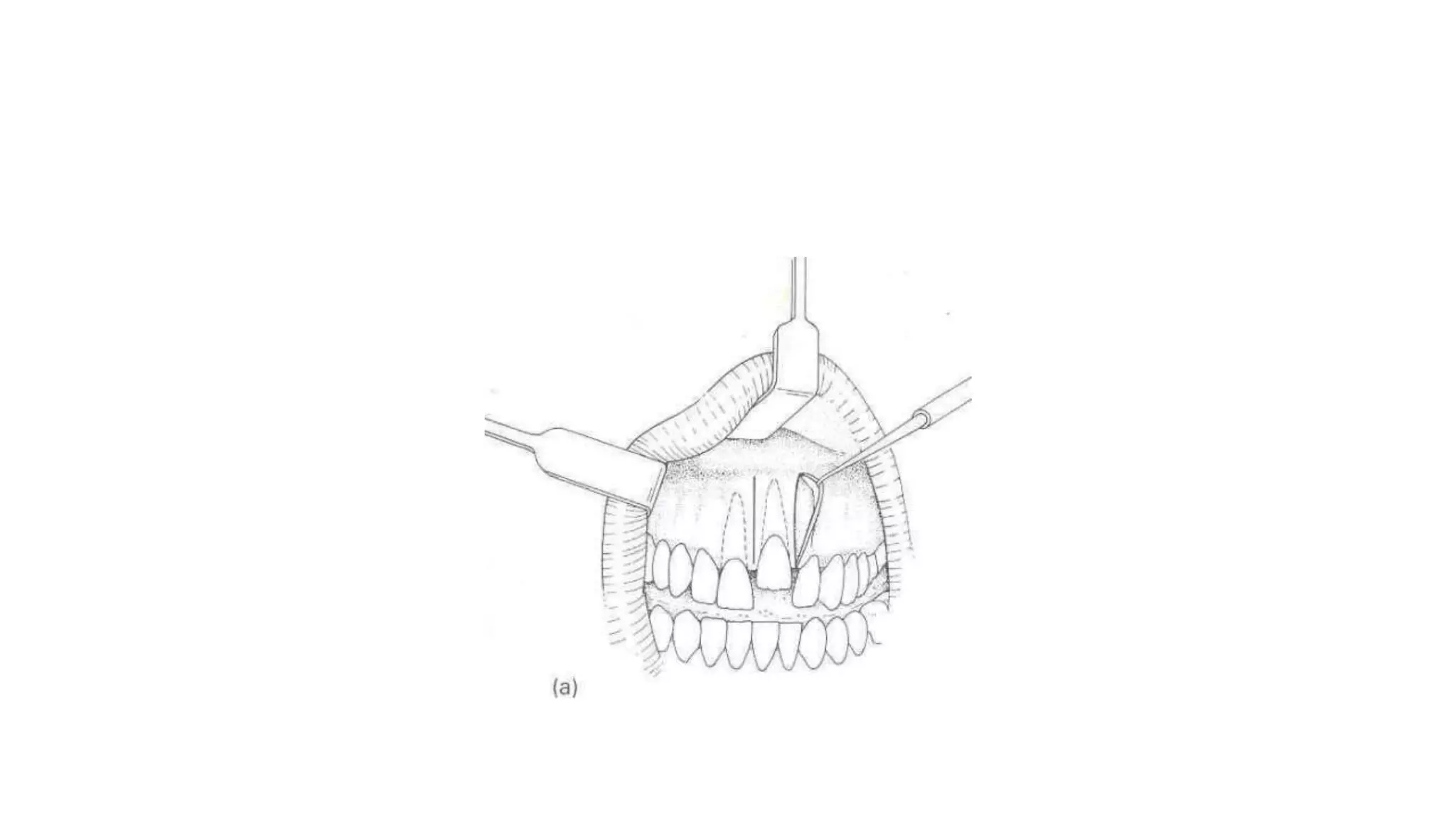 Maxillary Orthognathic Surgery | PPTX | Dental Health | Diseases and ...
