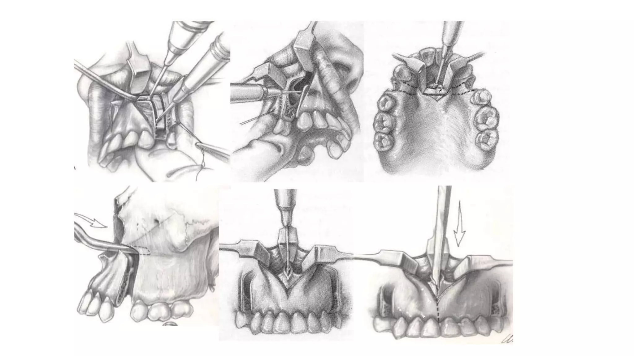 Maxillary Orthognathic Surgery | PPTX | Dental Health | Diseases and ...