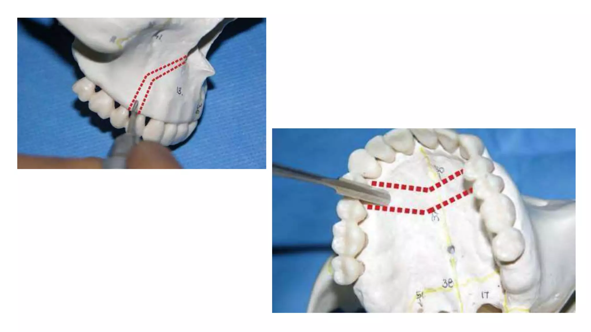 Maxillary Orthognathic Surgery | PPTX | Dental Health | Diseases and ...