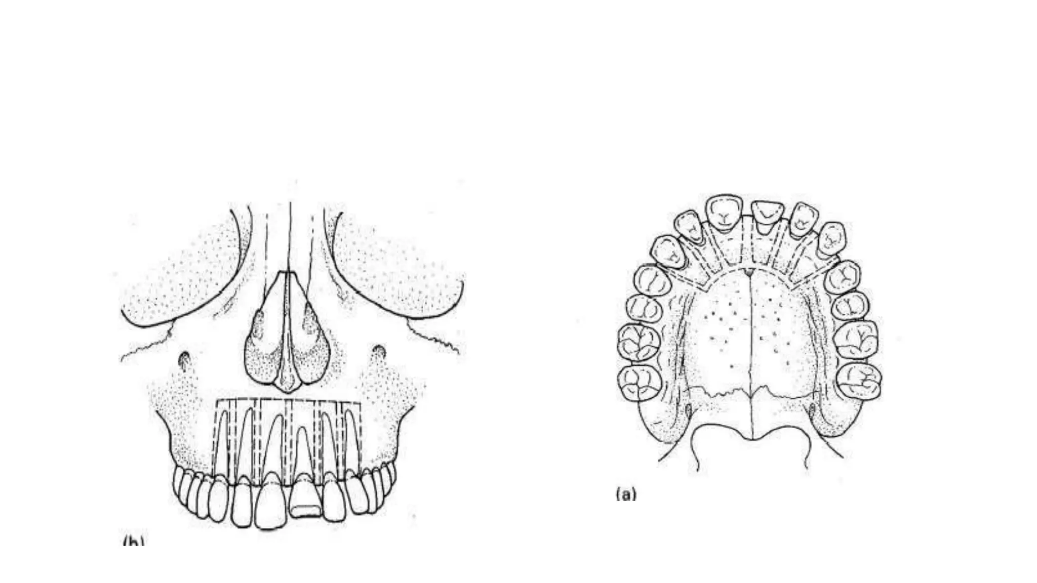 Maxillary Orthognathic Surgery | PPTX | Dental Health | Diseases and ...